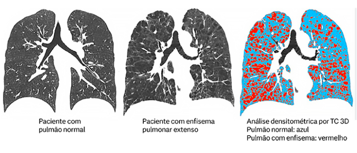 Enfisema pulmonar: o que é, sintomas, causas e tratamento | Nav Dasa