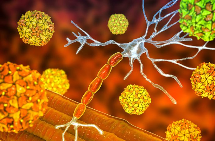 Poliomielite: o que é, causas e sintomas