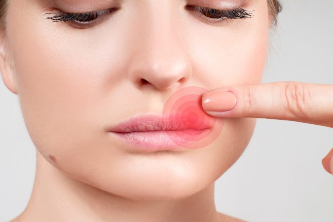 Herpes labial: sintomas,causas e tratamento | Nav Dasa