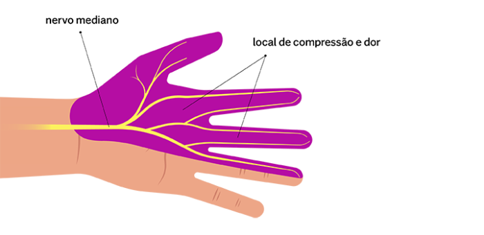 Síndrome do túnel do carpo: o que é, sintomas e tratamento | Nav Dasa