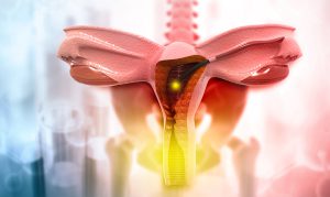 Histerectomia: o que é e como é feita a cirurgia| Nav Dasa