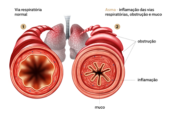 Asma: o que é, sintomas, causas, tratamento, tem cura? | Nav Dasa