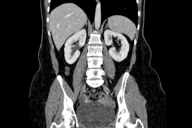 Apendicite: o que é, sintomas, causas e tratamento | Nav Dasa