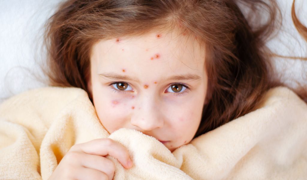 Catapora: o que é, transmissão e tratamento | Blog Nav Dasa