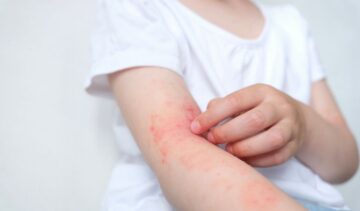 Dermatite: o que é, sintomas, tipos e tratamento | Blog Nav Dasa