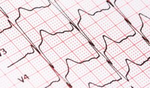Fibrilação atrial: entenda o que é, sintomas e tratamento