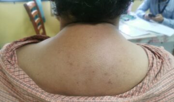 Síndrome de Cushing: o que é, causas e sintomas | Blog Nav Dasa