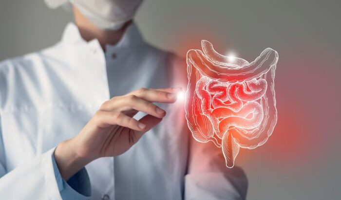 Pólipos no intestino: conheça as causas e sintomas