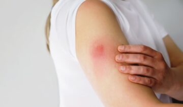 Sarna humana: o que é, sintomas e tratamento | Blog Nav Dasa