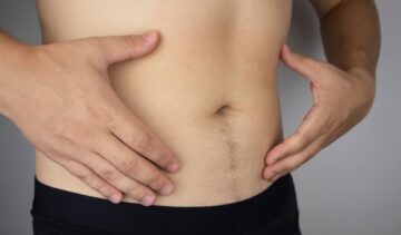 Ascite: causas, sintomas e tratamento | Nav Dasa