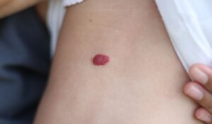 Hemangioma: o que é, causas e sintomas