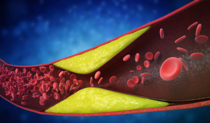 Dislipidemia: o que é, causas e tratamentos